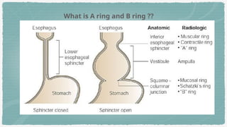 Radiographic imaging of esophageal strictures.pptx