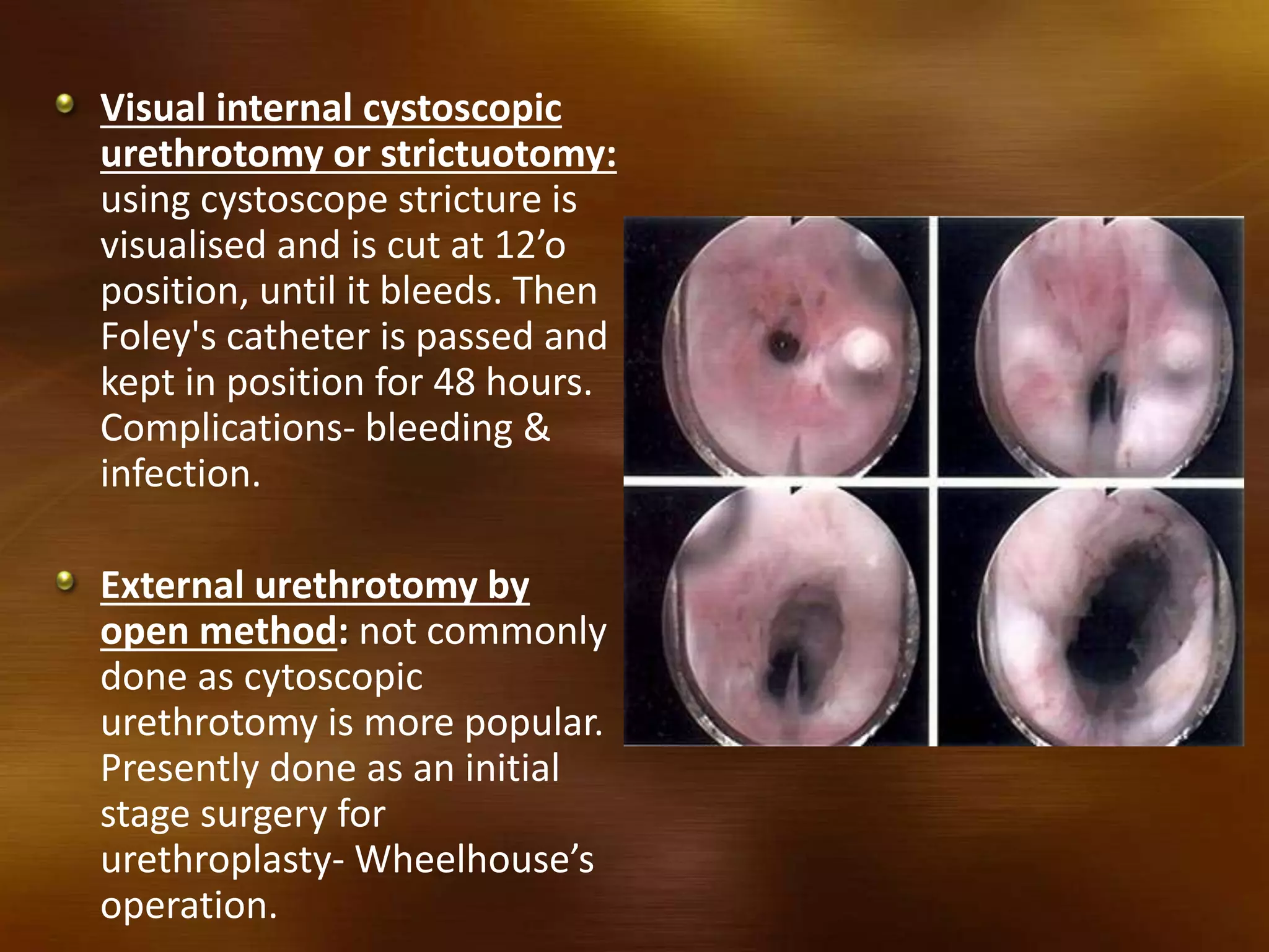 Stricture Urethra | PPT