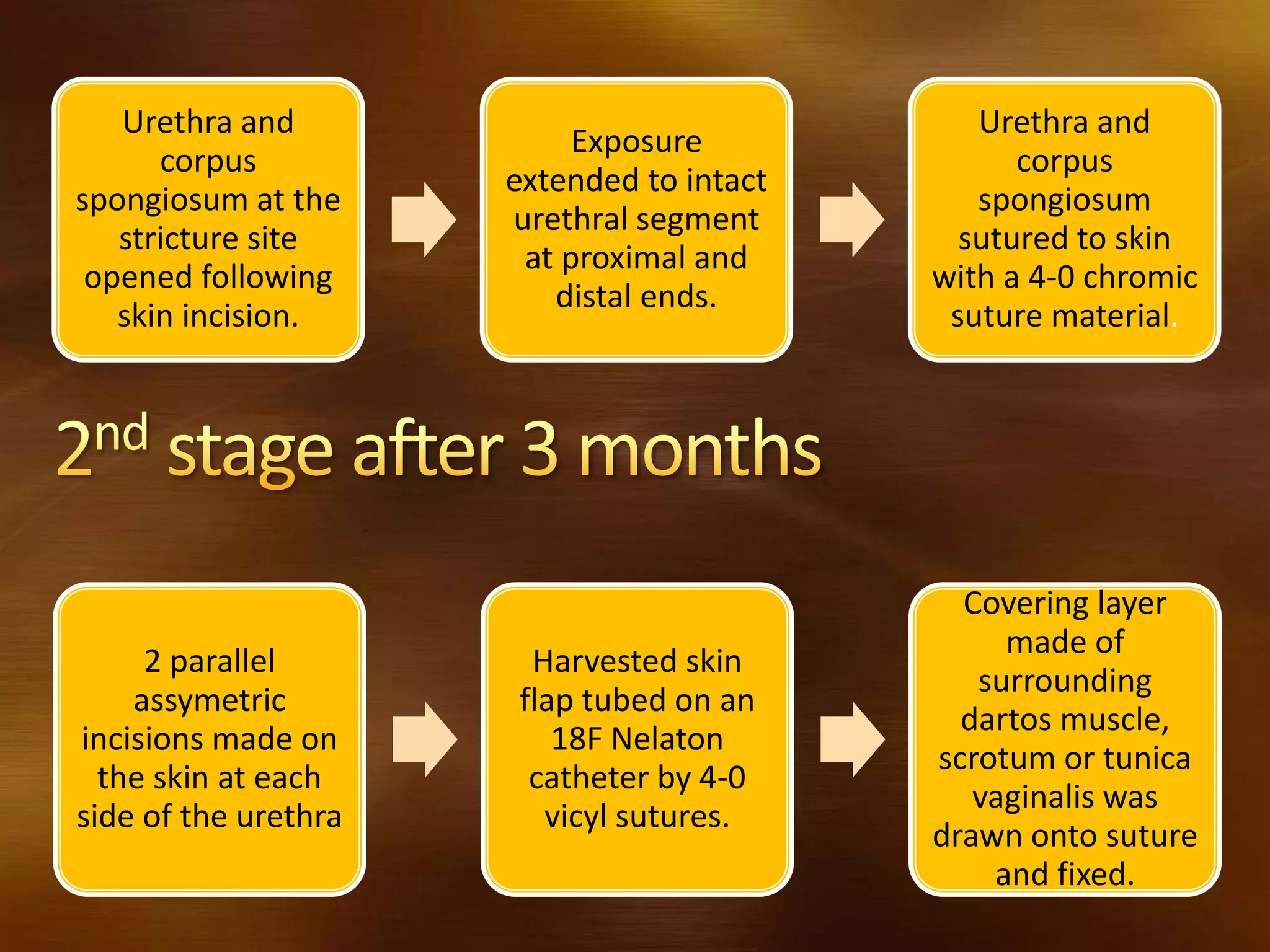Stricture Urethra | PPT