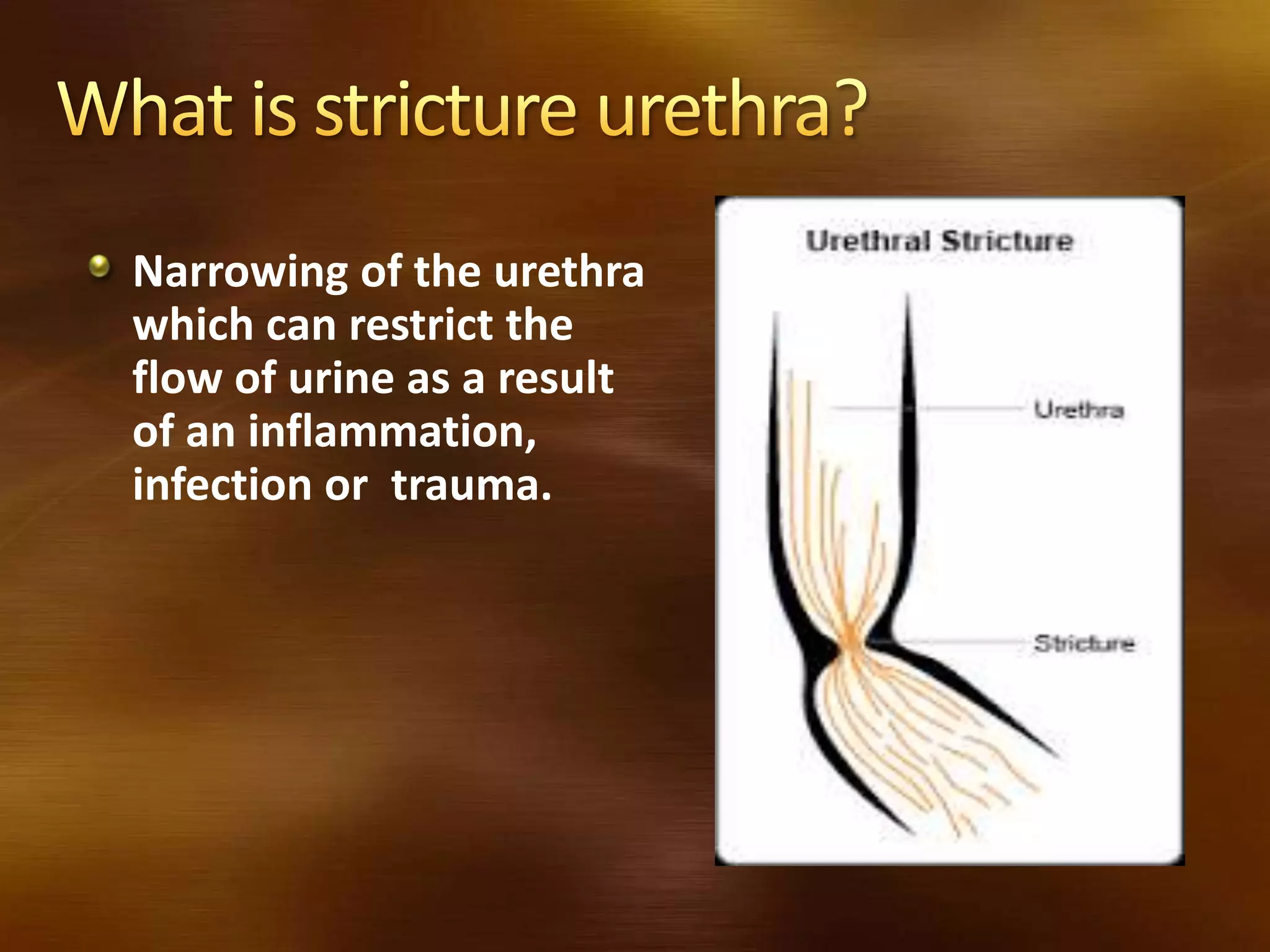 Stricture Urethra | PPT