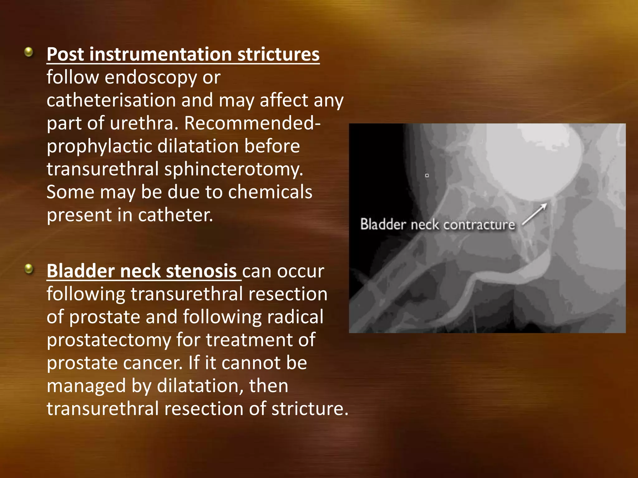 Stricture Urethra | PPT