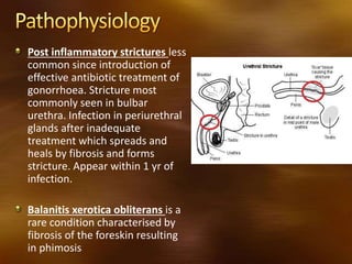 Stricture Urethra | PPTX