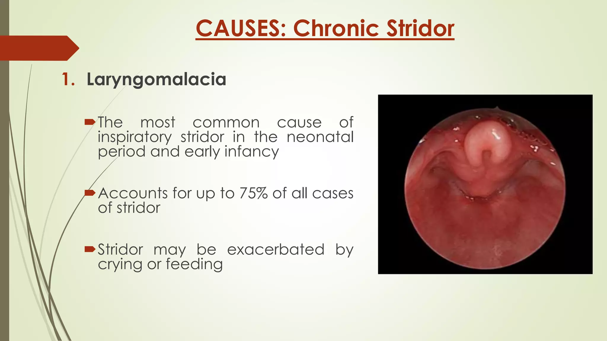 Stridor In Children | PPTX