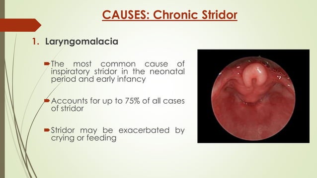 Stridor In Children | PPTX | Ear, Nose and Throat Conditions | Diseases ...