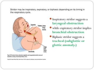 Stridor | PPT