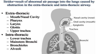 Stridor | PDF