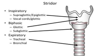 Stridor | PDF