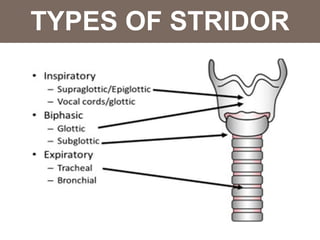 Stridor | PPTX