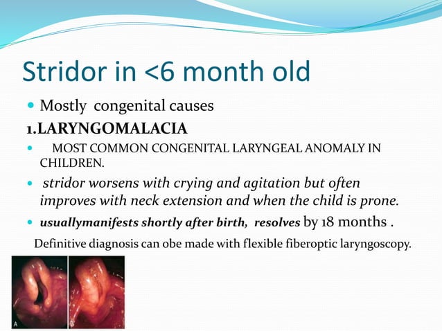 Stridor and drooling in infants and children | PPT