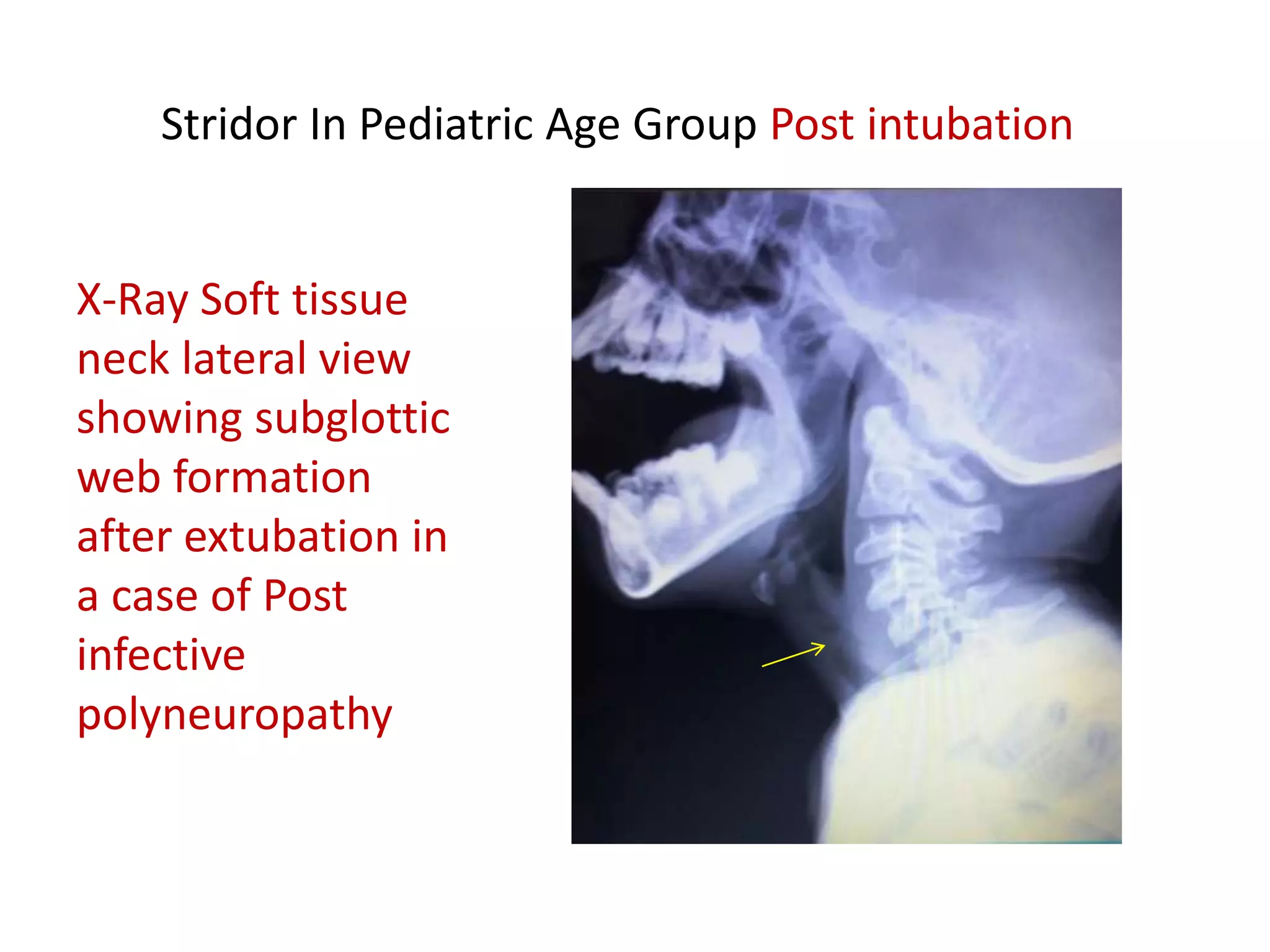 Stridor in pediatric age group | PPTX