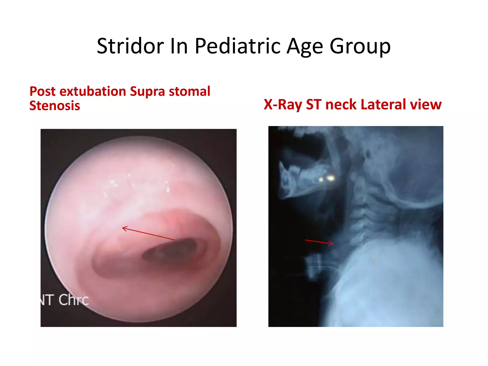 Stridor in pediatric age group | PPTX