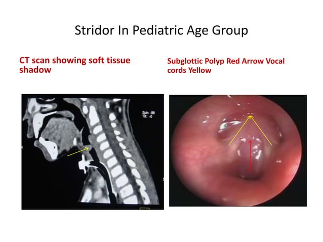 Stridor in pediatric age group | PPTX | Ear, Nose and Throat Conditions ...