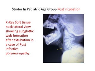 Stridor in pediatric age group | PPTX