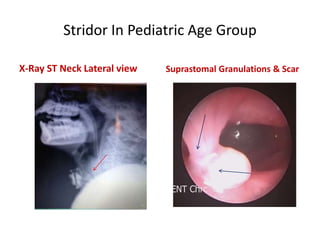 Stridor in pediatric age group | PPTX