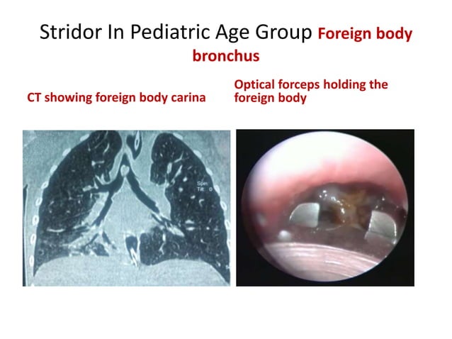 Stridor in pediatric age group | PPTX | Ear, Nose and Throat Conditions ...