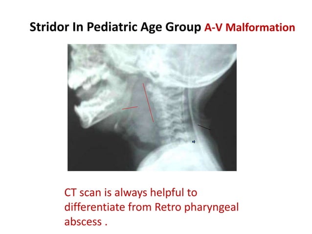 Stridor in pediatric age group | PPTX | Ear, Nose and Throat Conditions ...