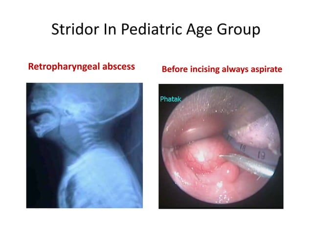Stridor in pediatric age group