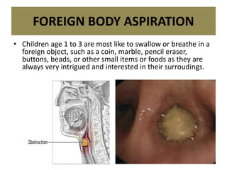 An approach to a case of Paediatric Stridor | PPTX