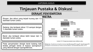 Striktur Urethra bedah urologi power point | PPTX