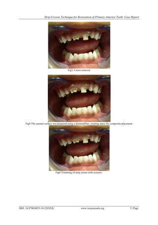 Strip Crowns Technique for Restoration of Primary Anterior Teeth: Case ...