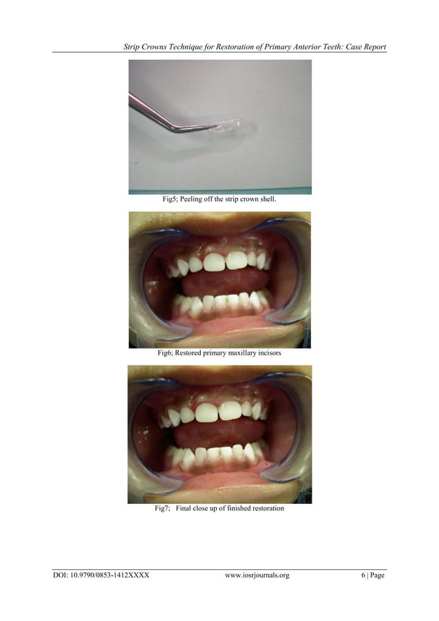 Strip Crowns Technique for Restoration of Primary Anterior Teeth: Case ...