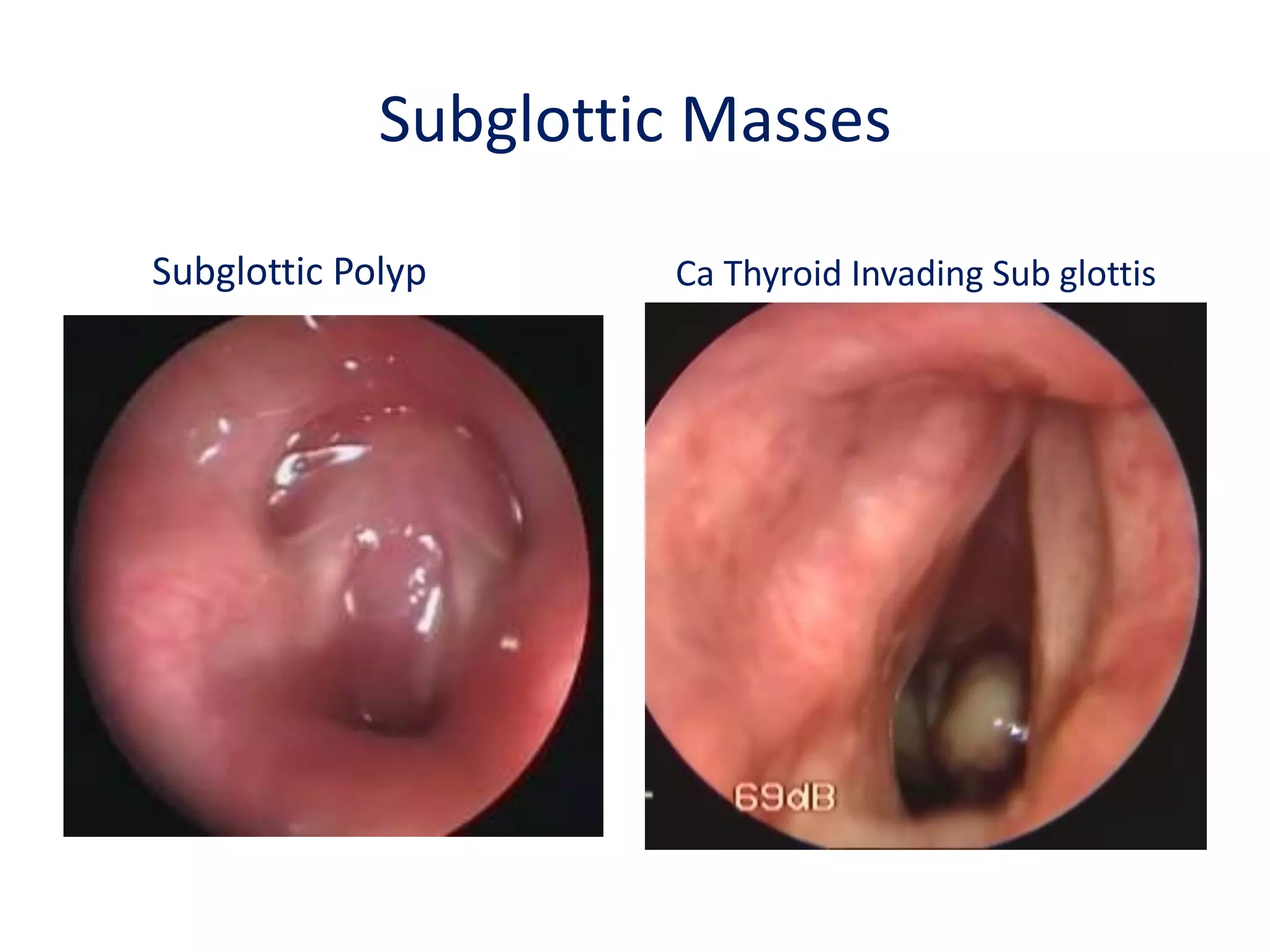 Stroboscopy larynx | PPTX