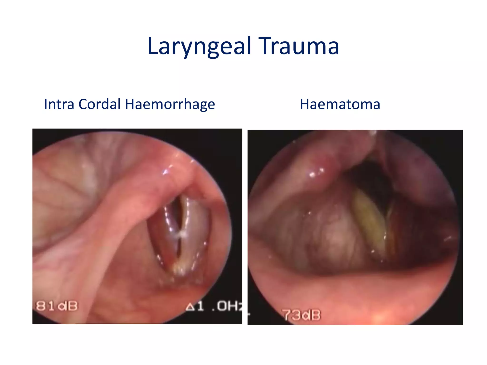 Stroboscopy larynx | PPTX