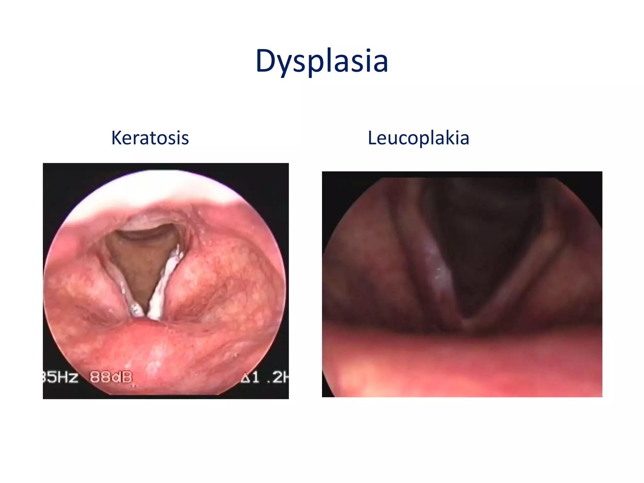 Stroboscopy larynx | PPTX