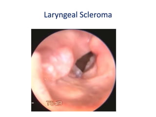 Stroboscopy larynx | PPTX