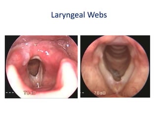 Stroboscopy larynx | PPTX