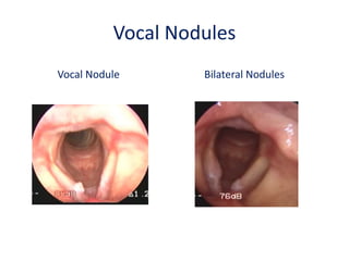Stroboscopy larynx | PPTX