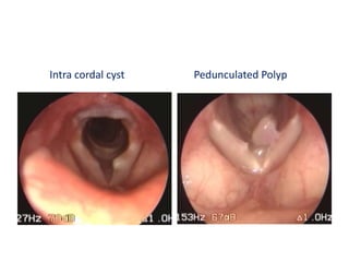 Stroboscopy larynx | PPTX
