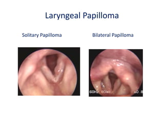 Stroboscopy larynx | PPTX