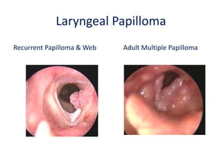 Stroboscopy larynx | PPTX