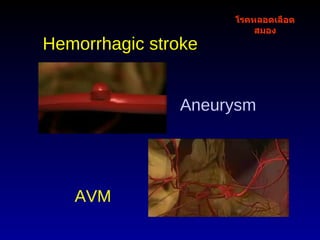 Stroke | PPT