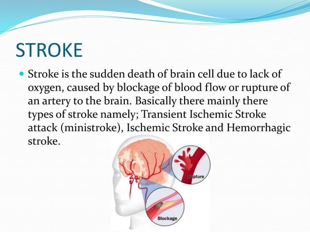 STROKE PRESENTATION NOTES IN POWERPOINT. | PPT | Free Download