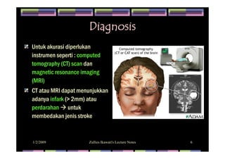 Stroke | PDF