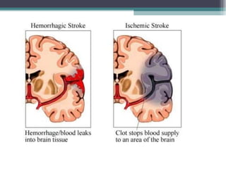 stroke-130711163114-phpapp01.pptx