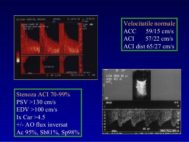 ULTRASONOGRAFIA CAROTIDIANA IN STROKE