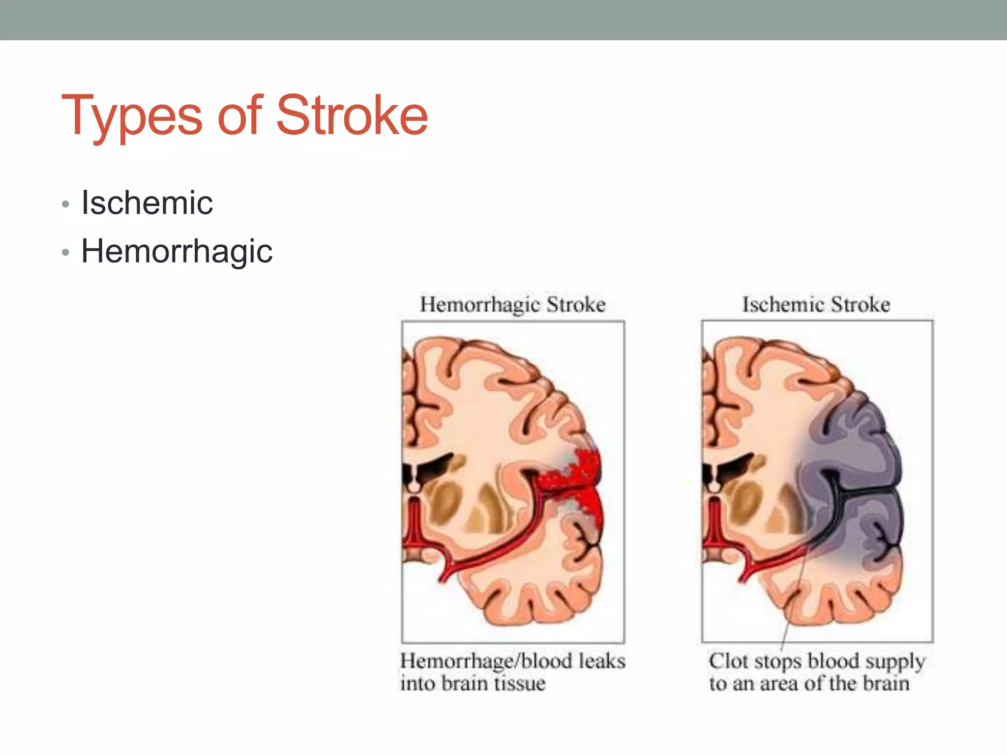 Ischemic and hemorrhagic stroke | PPTX