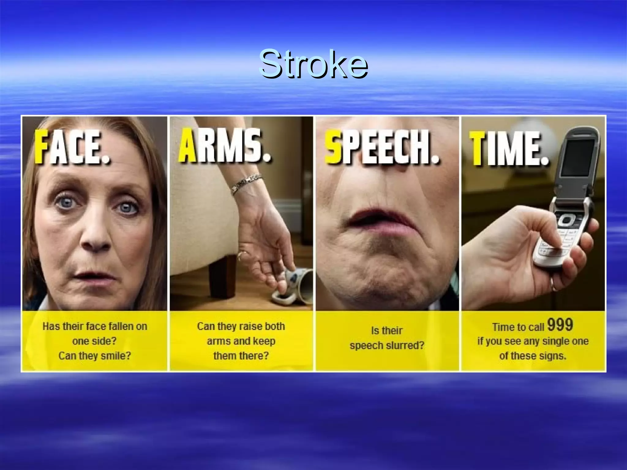Stroke - Cerebrovascular Accident - (CVA) | PPT