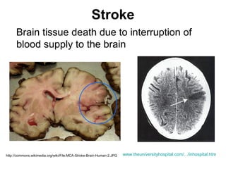 Stroke | PPT