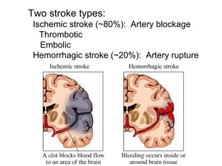 Stroke | PPT
