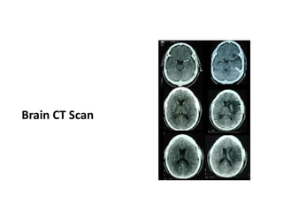 Stroke Made EASY | PDF