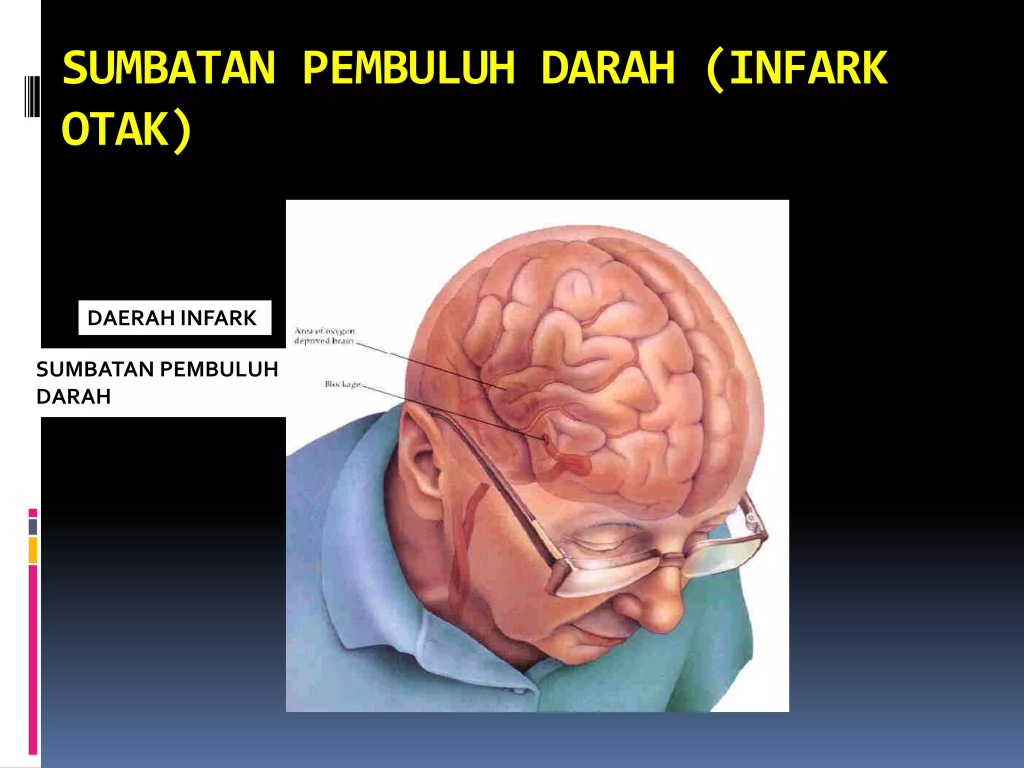 Asuhan Keperawatan pada pasien Stroke | PPTX