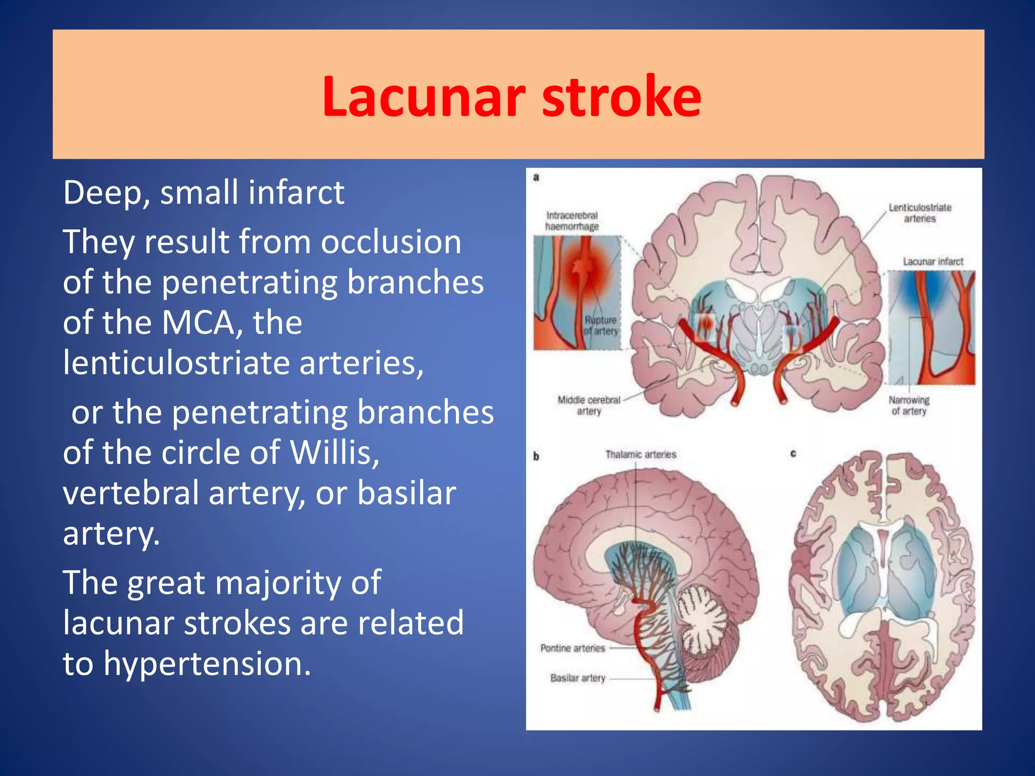Stroke | PPTX | Brain and Nervous System Disorders | Diseases and ...