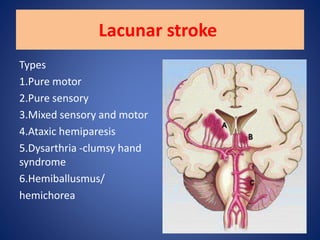 Stroke | PPTX | Brain and Nervous System Disorders | Diseases and Conditions