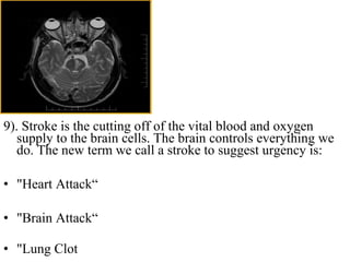 Stroke Quiz | PPT | Brain and Nervous System Disorders | Diseases and ...