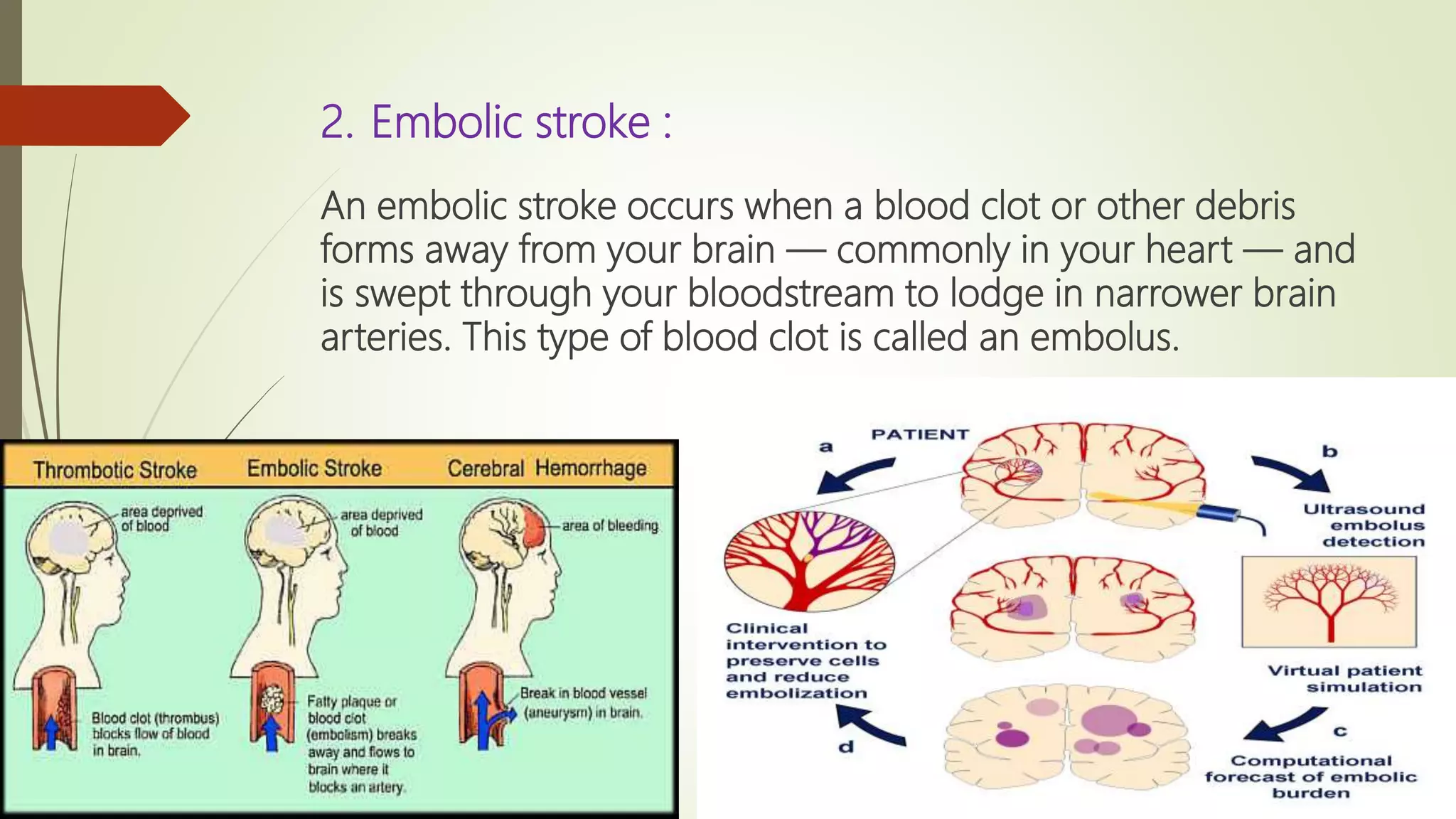 Stroke | PPTX