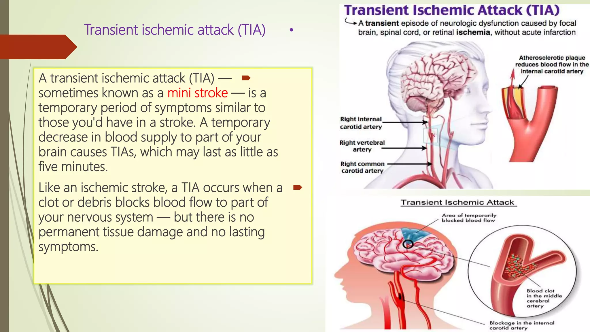 Stroke | PPTX
